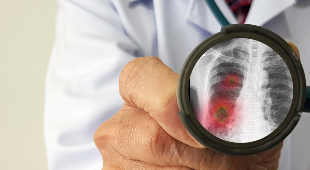 Pneumonia: sintomas, tipos e como é o tratamento